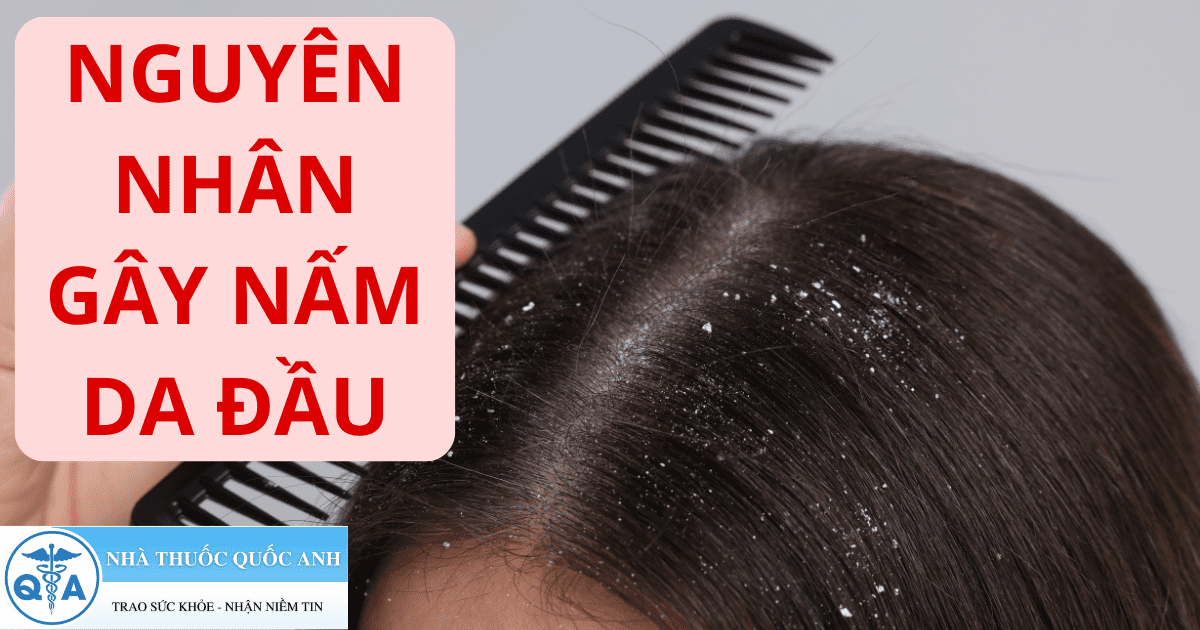 Nấm da đầu - Nguyên nhân, dấu hiệu và cách phòng ngừa