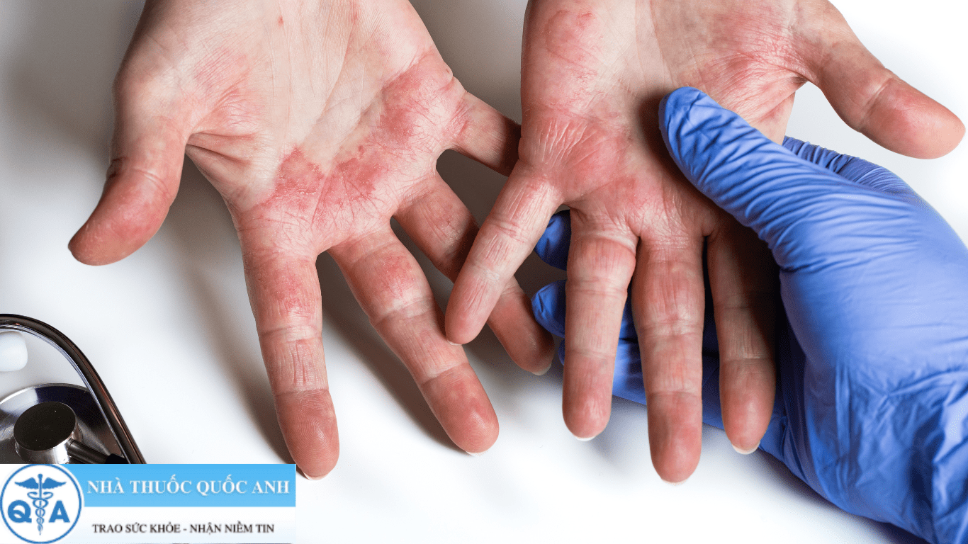 Viêm da cơ địa: Dấu hiệu nhận biết và cách phòng ngừa